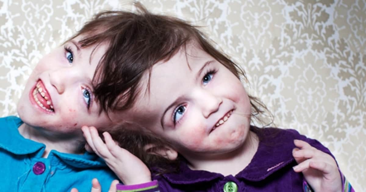 De Siamese tweeling die de wetenschap met verstomming slaat. ‘Elke ...